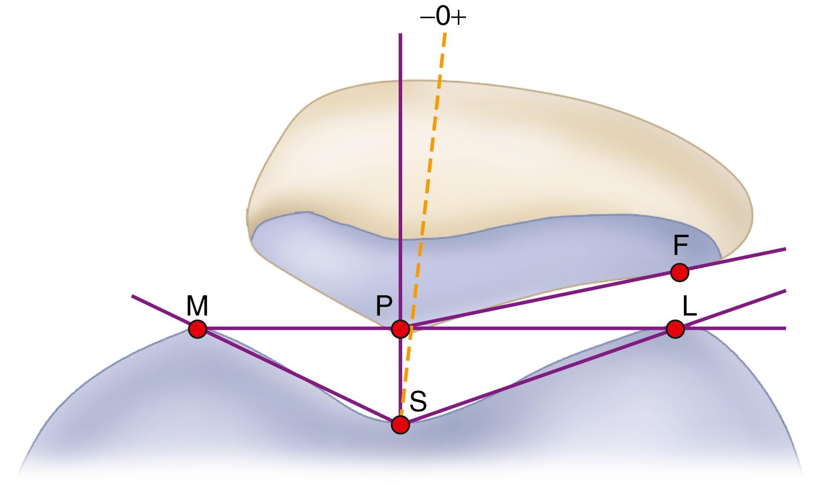 Recurrent Dislocations - Clinical Tree