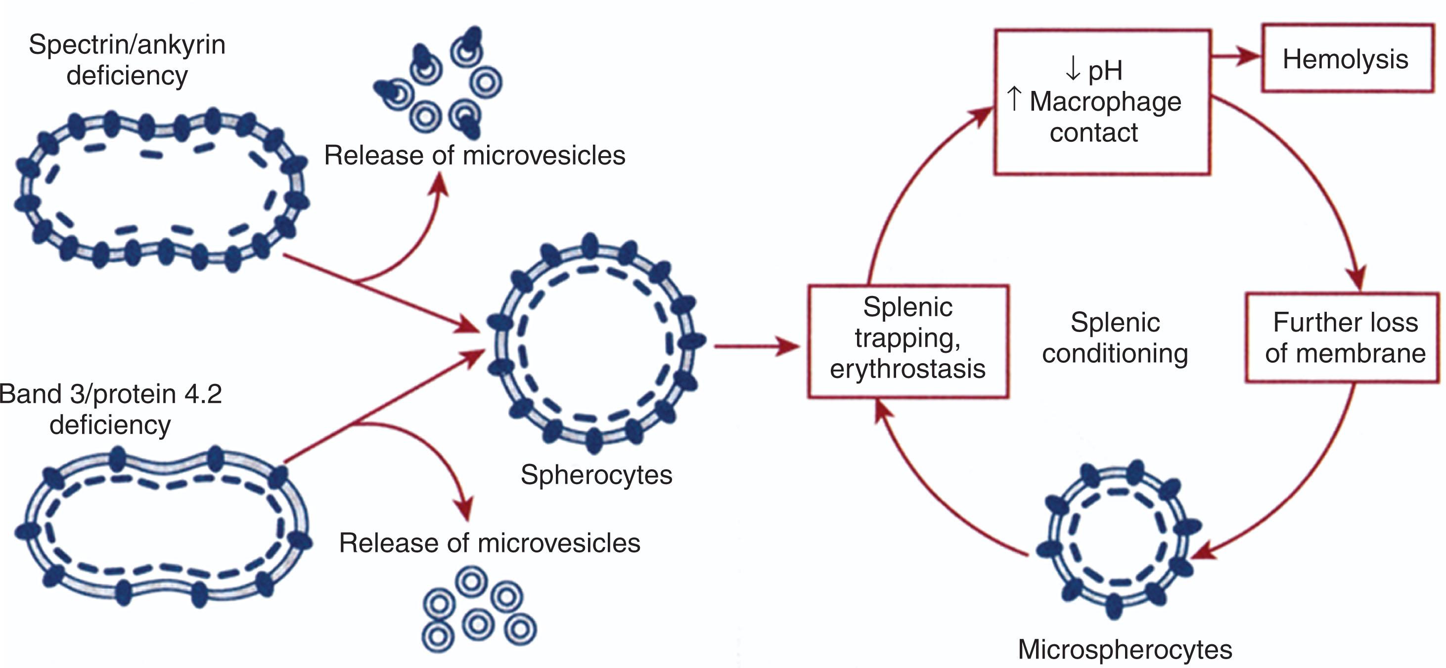 Red Blood Cell Membrane Disorders - Clinical Tree