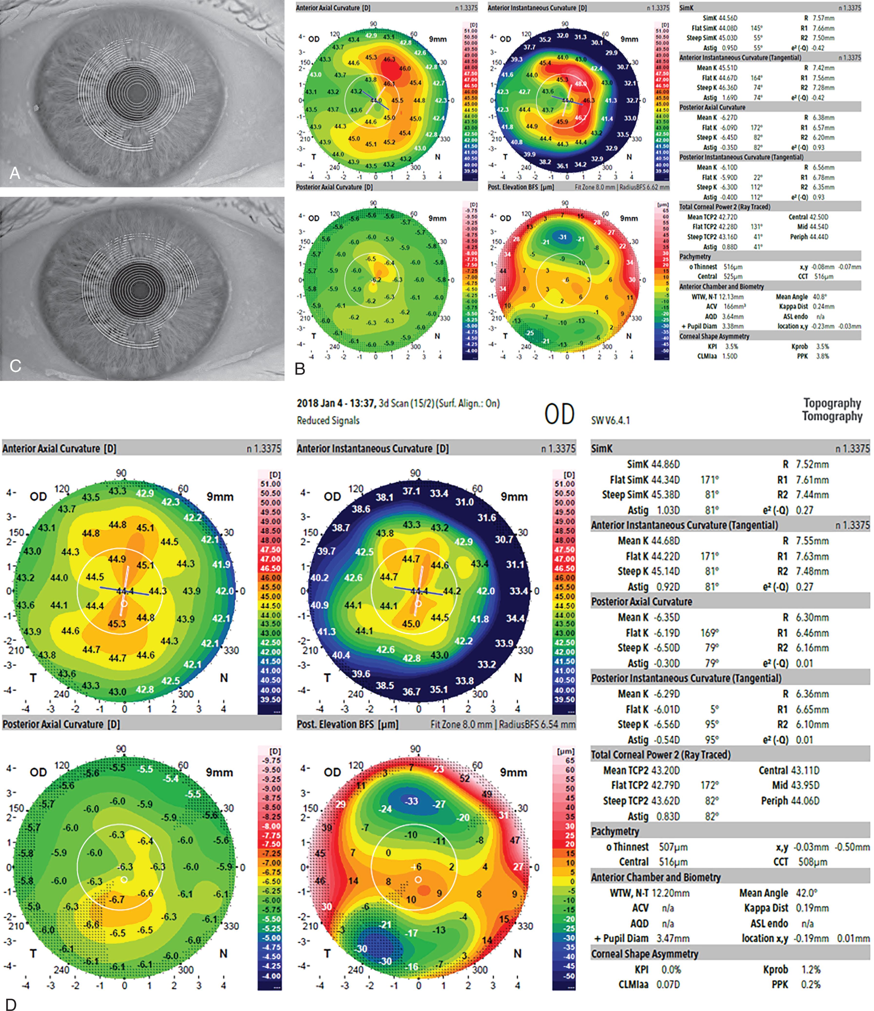 Refractive Enhancements After Cataract Surgery - Clinical Tree