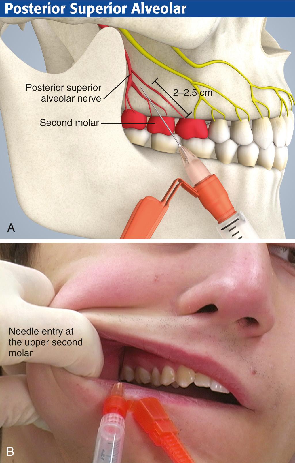 Regional Anesthesia of the Head and Neck - Clinical Tree
