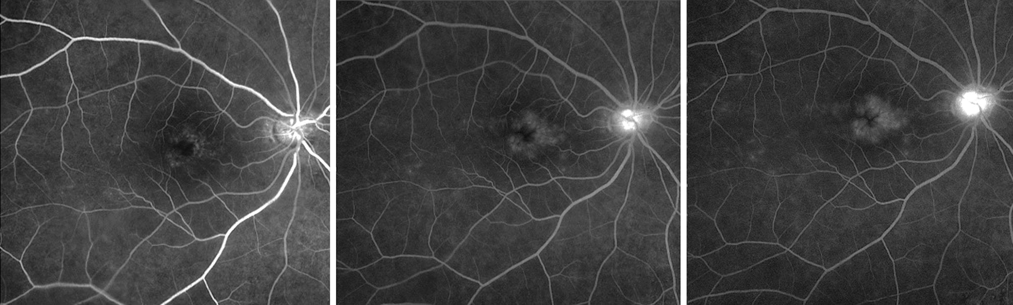 Retinal Complications of Cataract Surgery - Clinical Tree