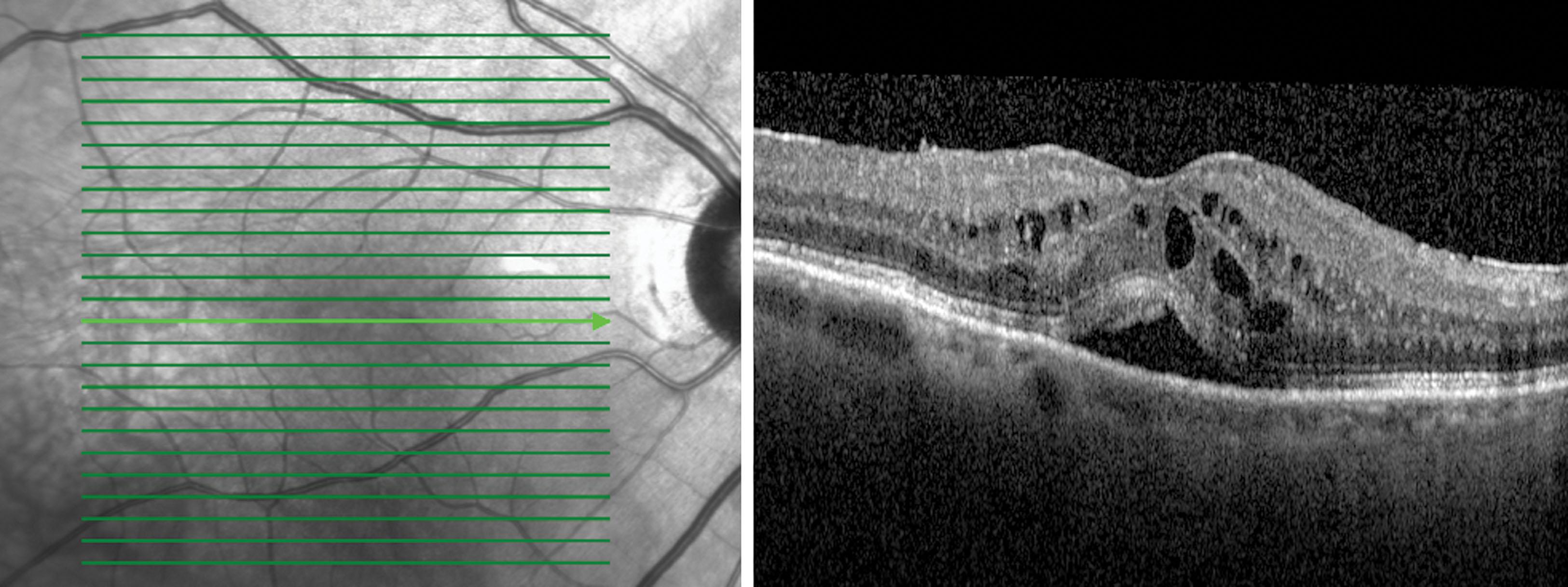 Retinal Complications of Cataract Surgery - Clinical Tree