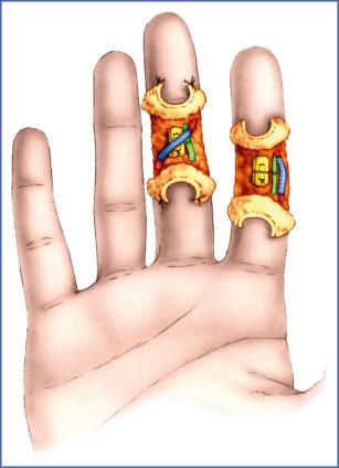 Revascularization - Clinical Tree