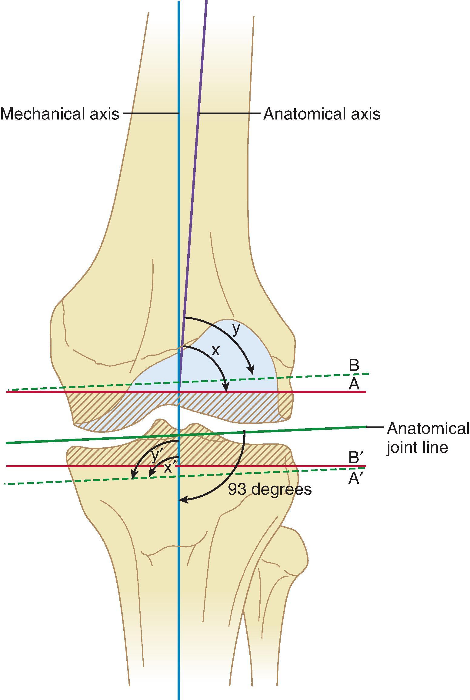 Revision Total Knee Arthroplasty Using Kinematic Alignment Principles ...