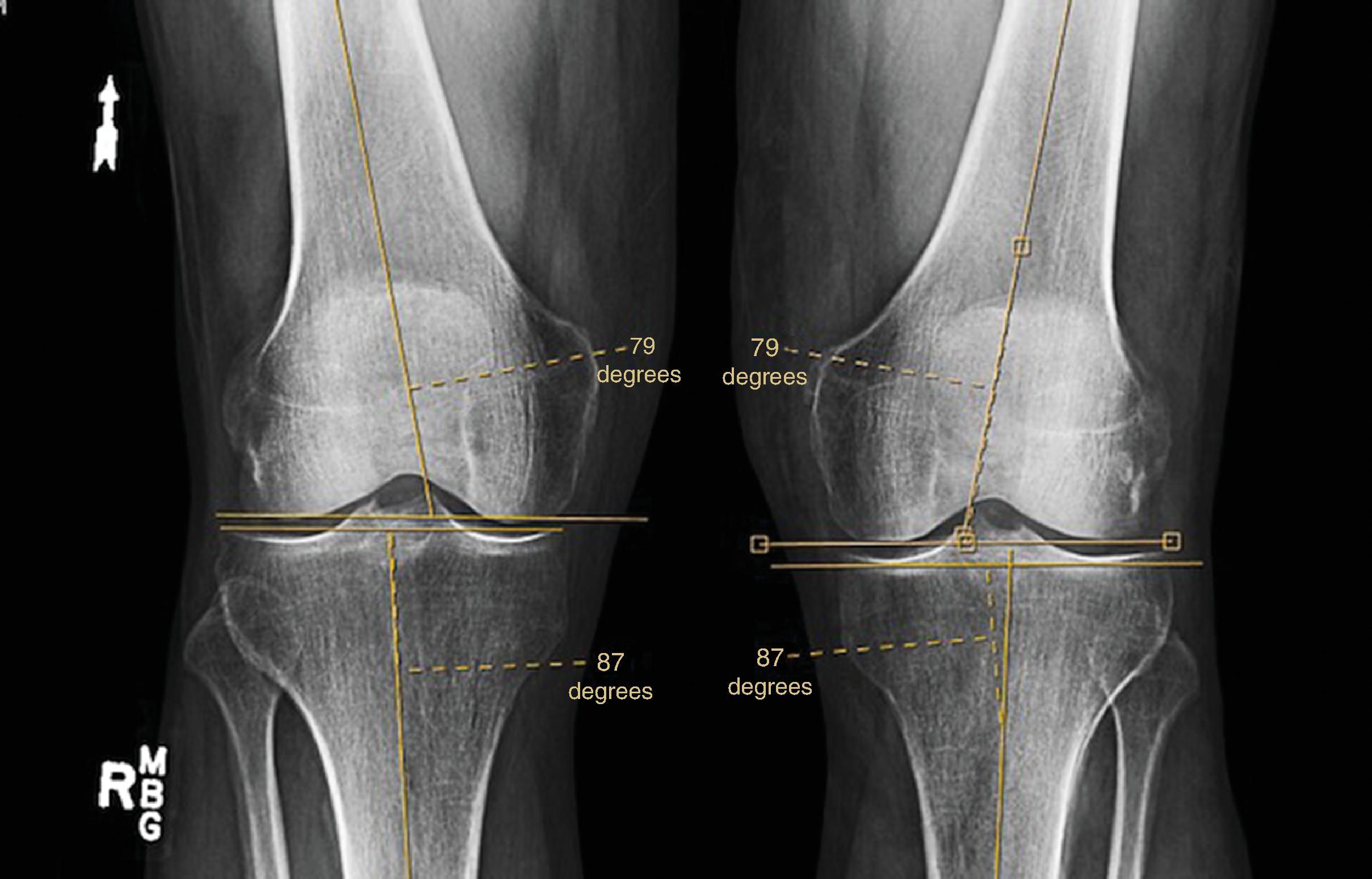 Revision Total Knee Arthroplasty Using Kinematic Alignment Principles ...