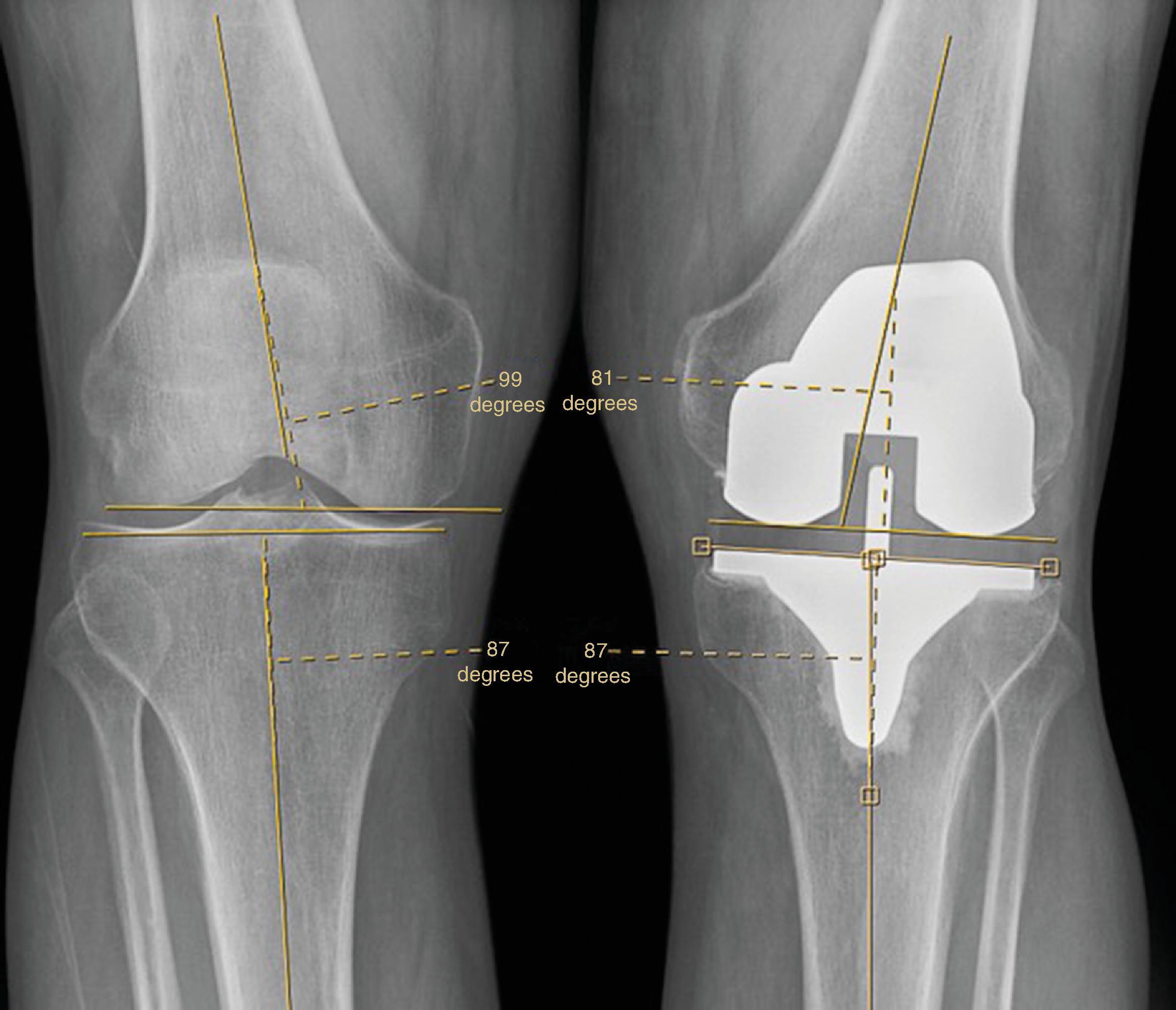 Revision Total Knee Arthroplasty Using Kinematic Alignment Principles ...