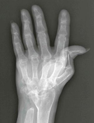 Rheumatoid Arthritis - Clinical Tree