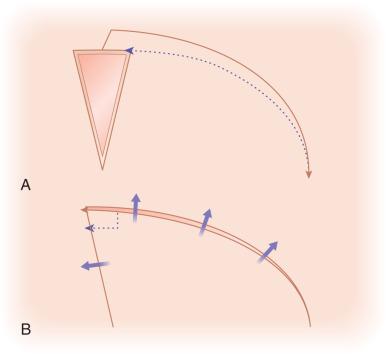 Rotation Flaps - Clinical Tree
