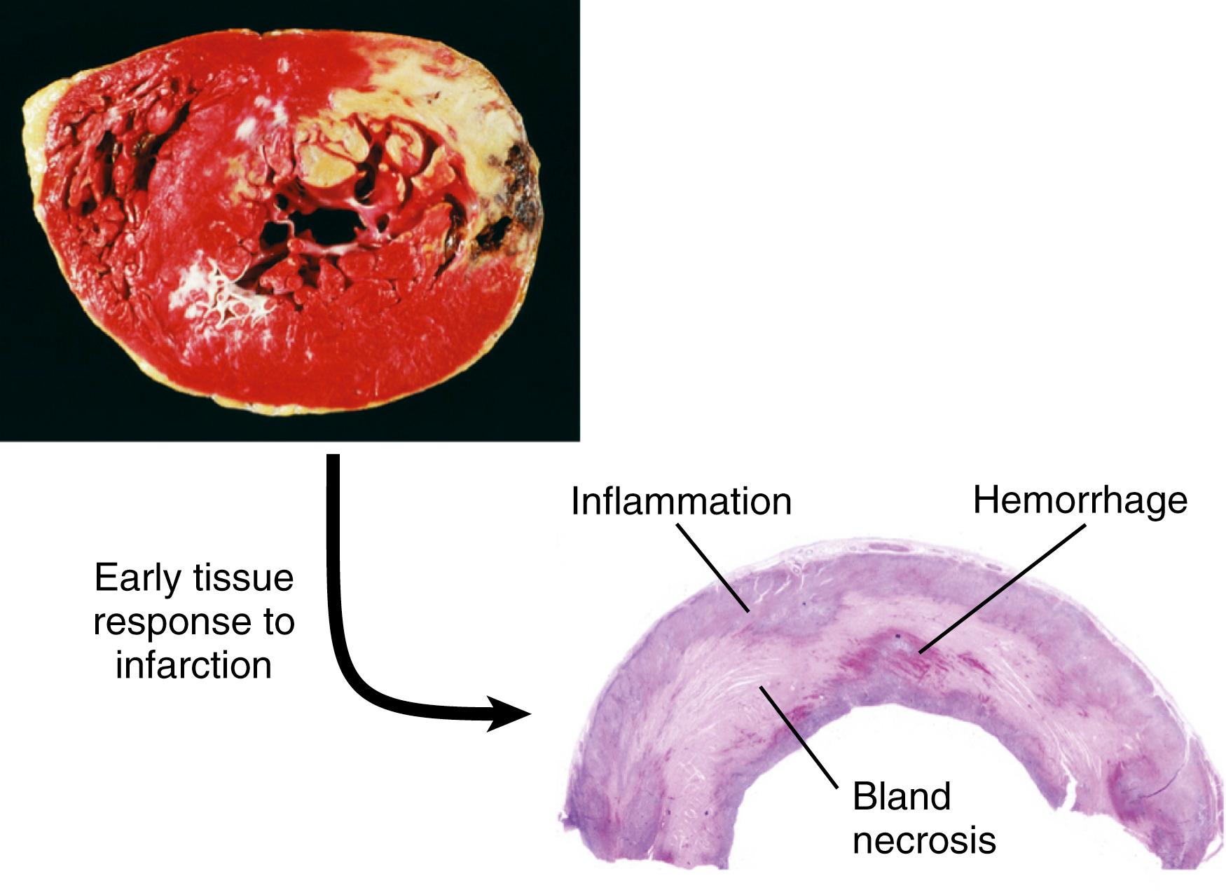 ST-Elevation Myocardial Infarction: Pathophysiology and Clinical ...
