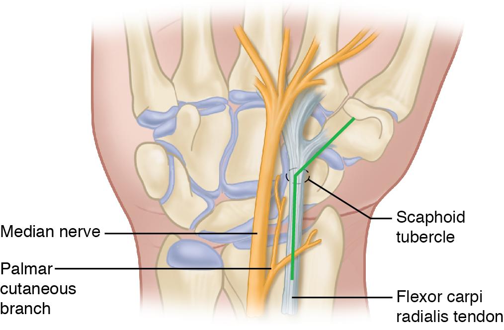 Scaphoid fractures: Open reduction internal fixation and percutaneous ... Scaphoid fractures: Open reduction internal fixation and percutaneous ...