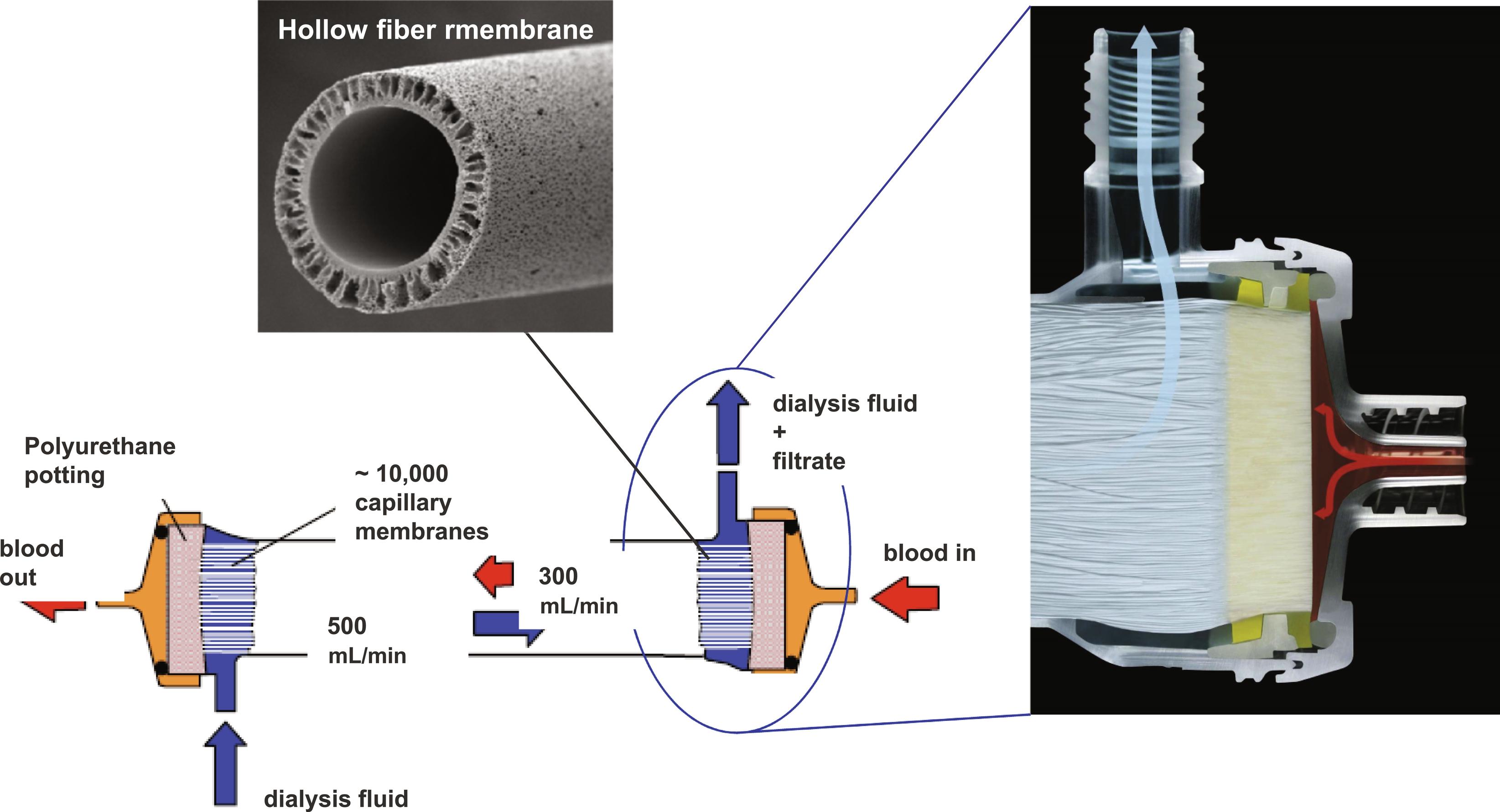 Selecting a Dialyzer: Technical and Clinical Considerations - Clinical Tree