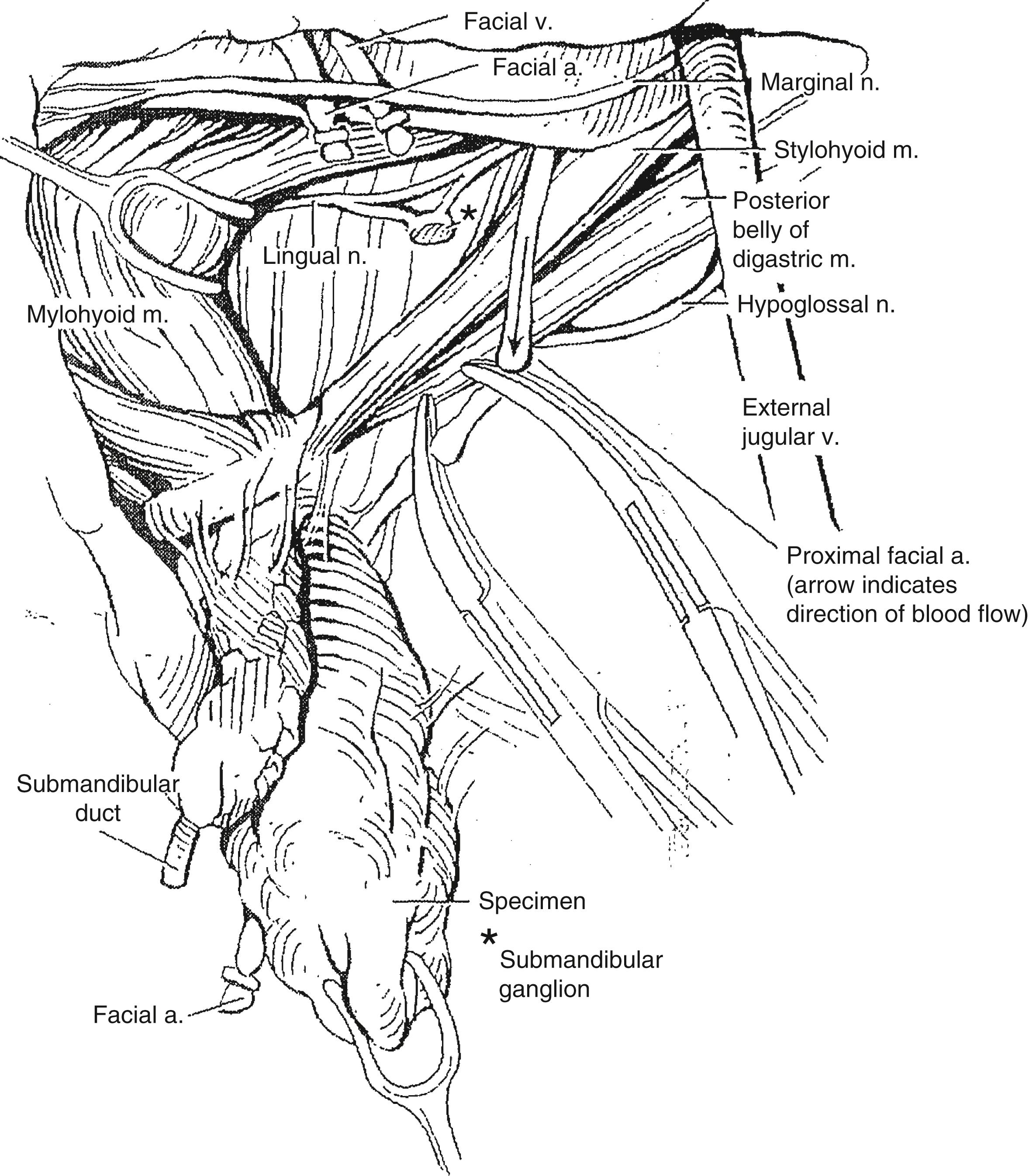 Selective Neck Dissection - Clinical Tree