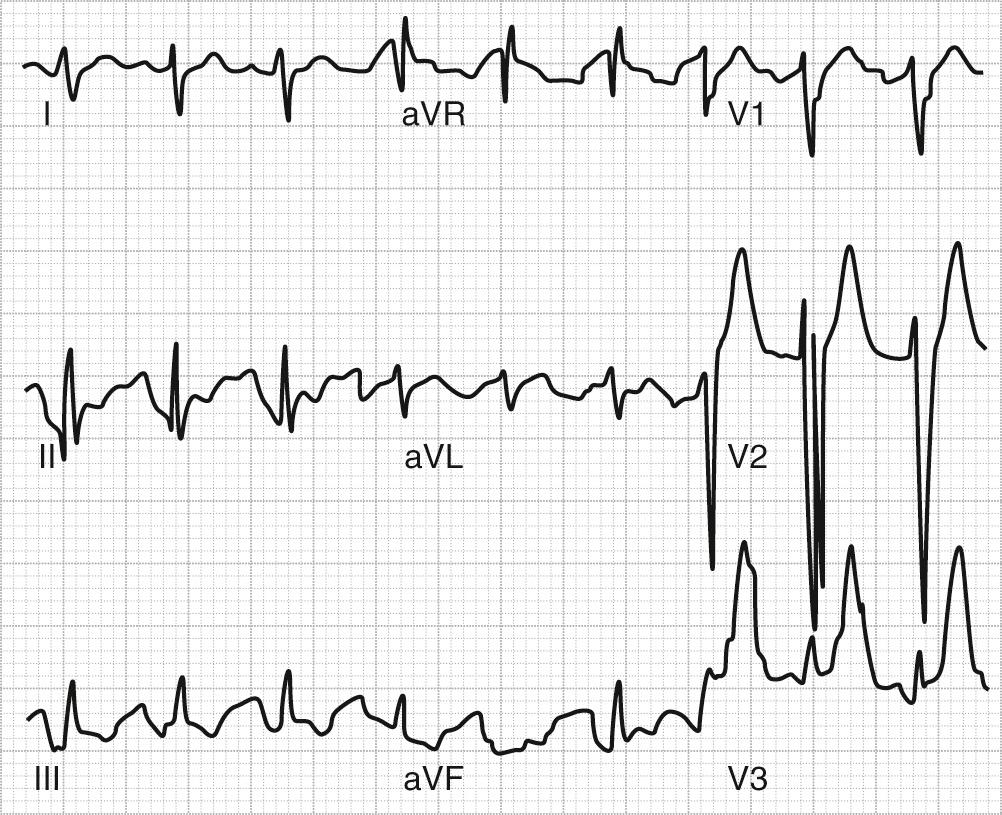 Side Effects of Psychotropic Medications - Clinical Tree