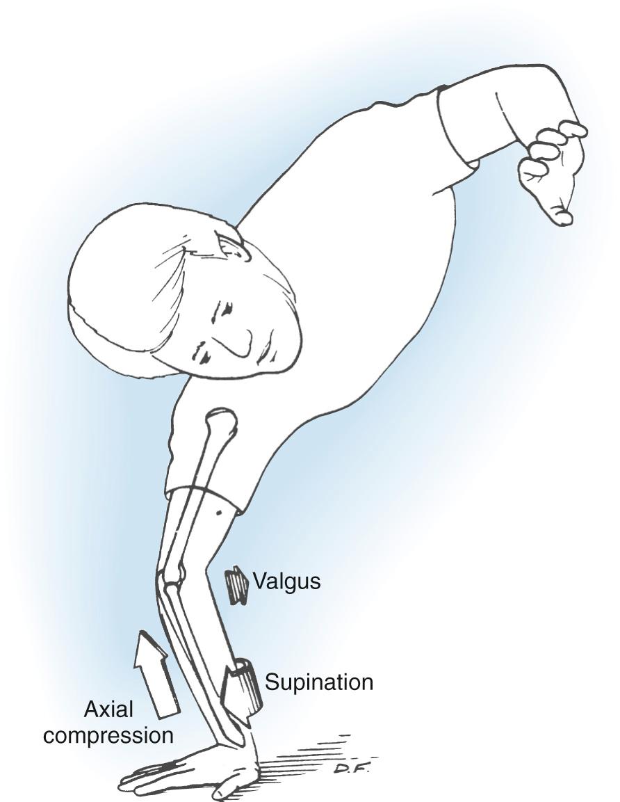 Simple Elbow Dislocation - Clinical Tree