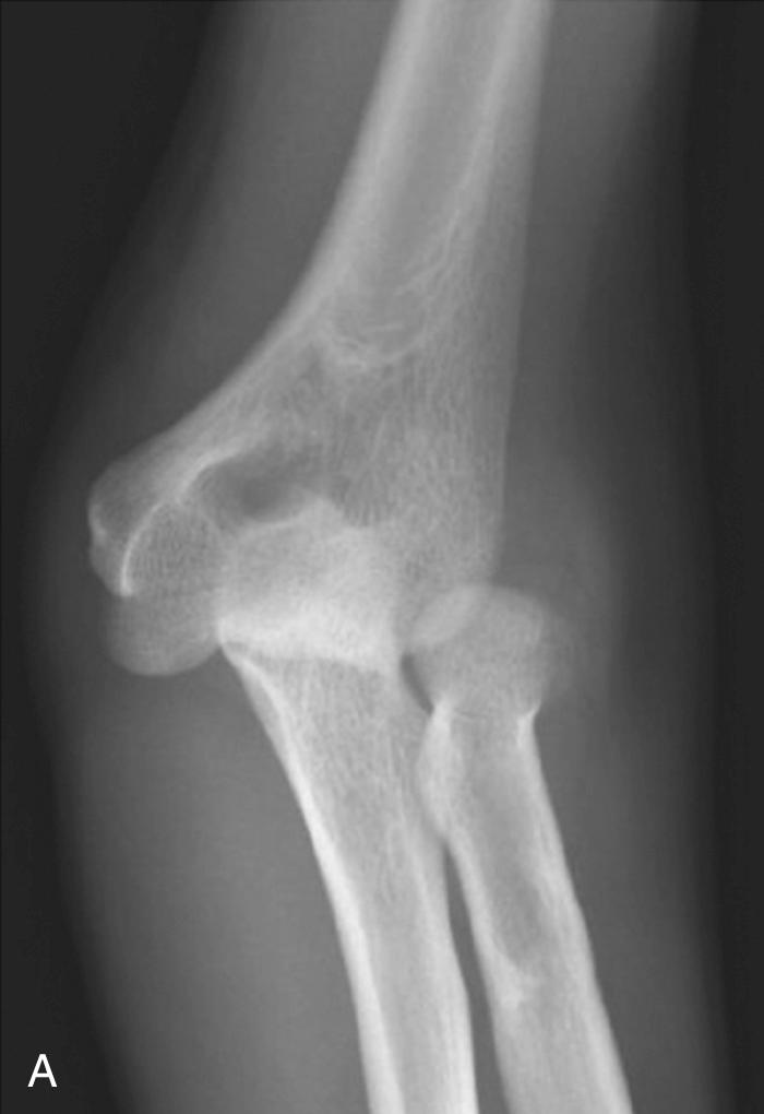 Simple Elbow Dislocation - Clinical Tree