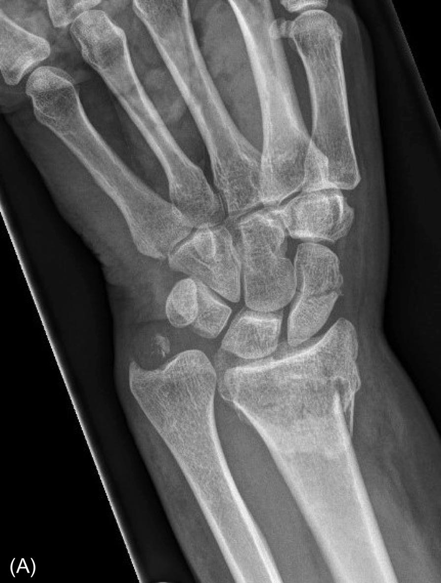Simultaneous Fractures of the Distal Radius and Scaphoid - Clinical Tree
