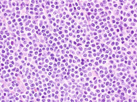 Small B-Cell Lymphomas - Clinical Tree
