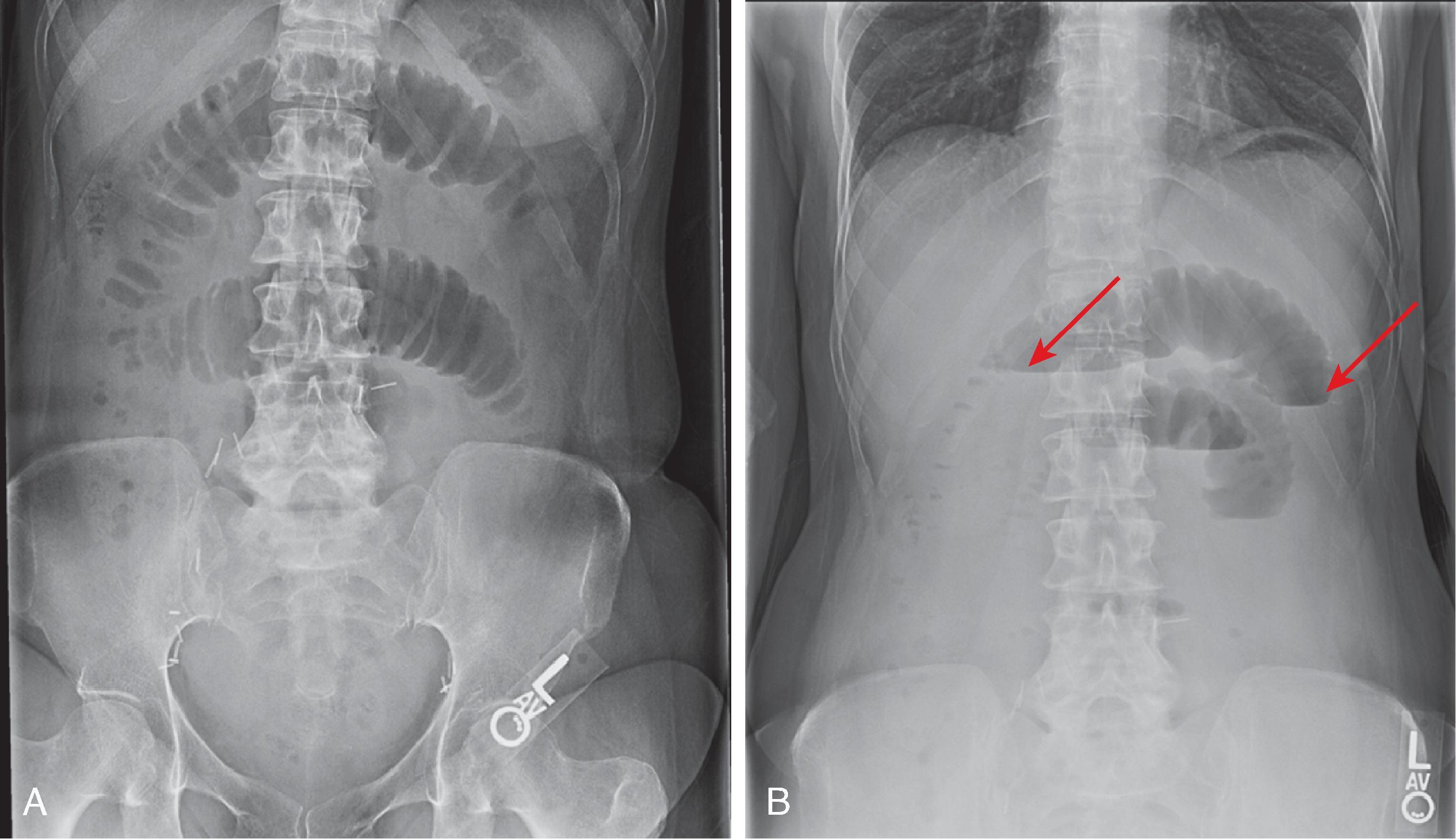Small Bowel Obstruction - Clinical Tree Small Bowel Obstruction - Clinical Tree