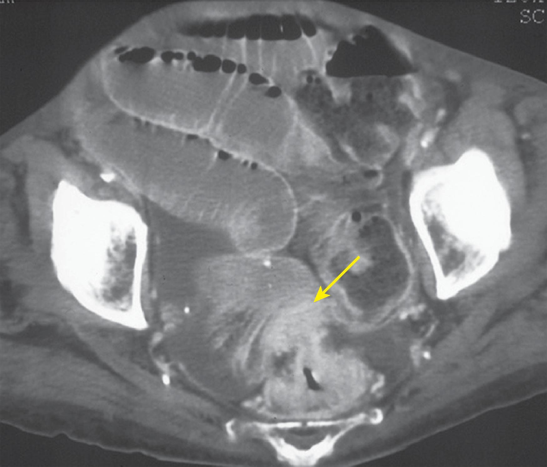 Small Bowel Obstruction - Clinical Tree