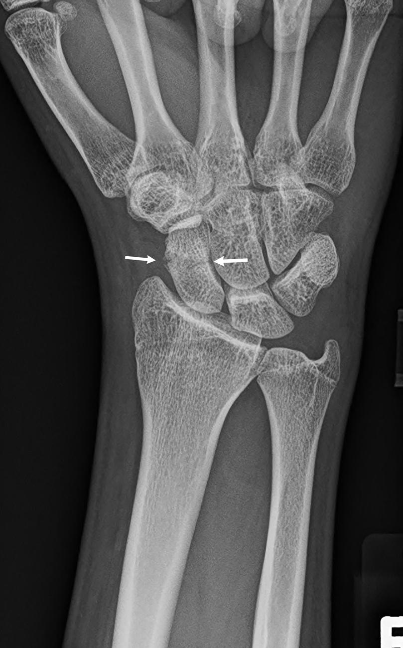 Snuffbox? Scaphoid fractures - Clinical Tree