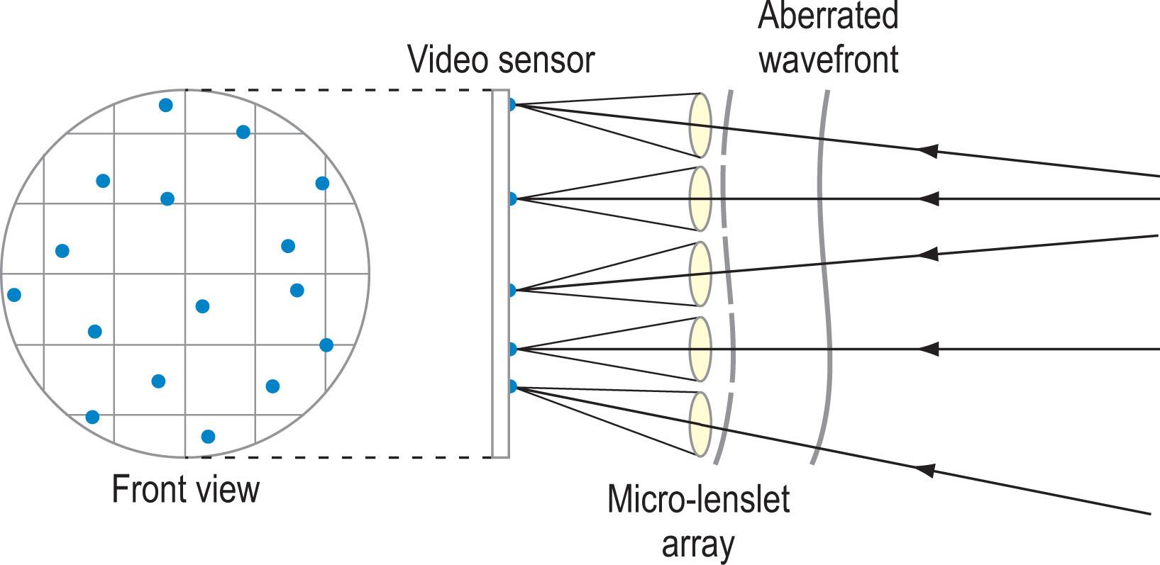 Soft Lens Measurement - Clinical Tree