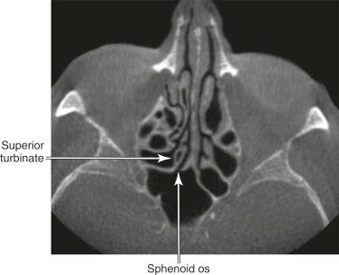 Sphenoidotomy - Clinical Tree
