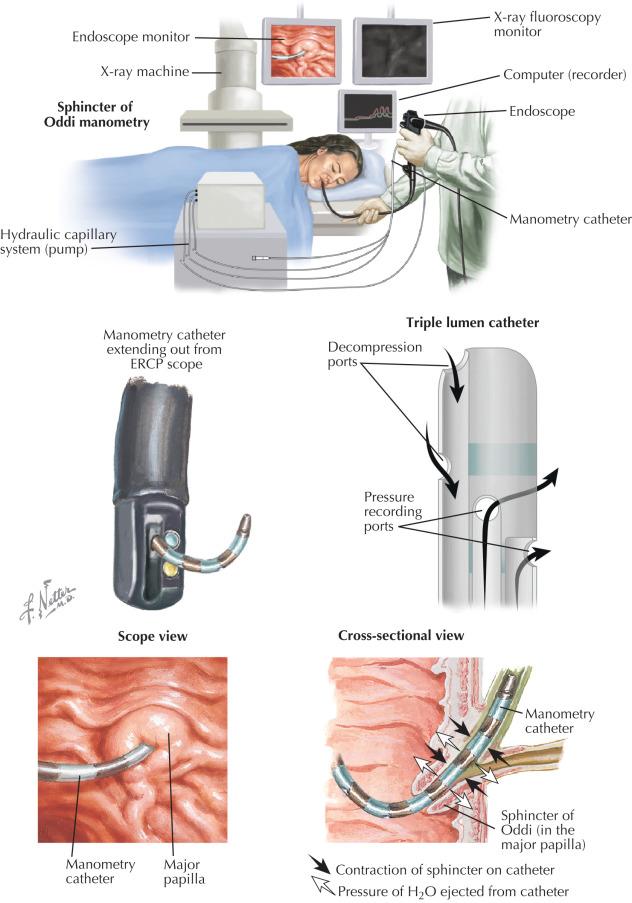 Sphincter of Oddi Dysfunction - Clinical Tree