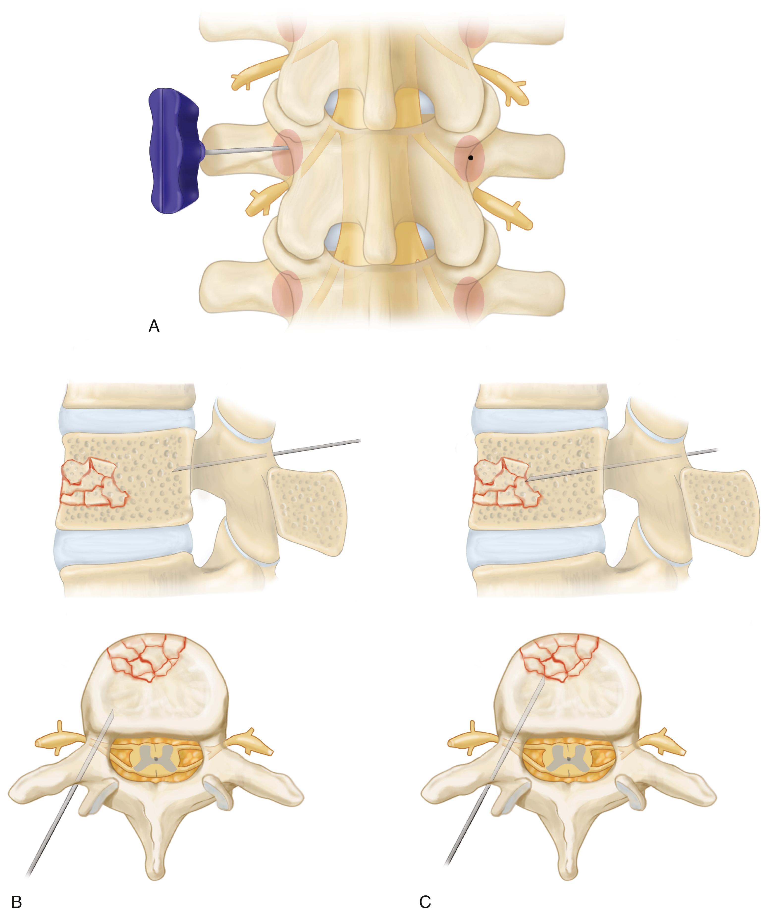 Spinal Augmentation for Vertebral Compression Fractures - Clinical Tree