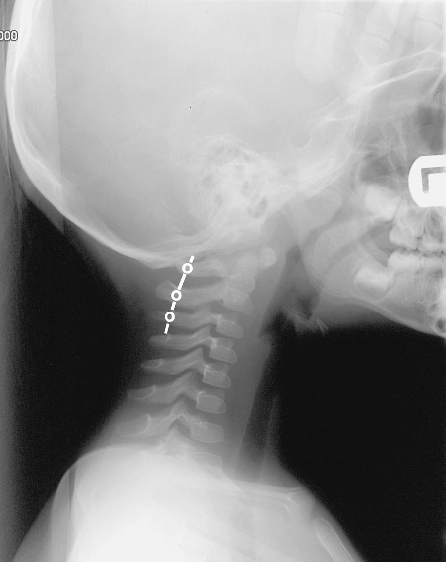 Spinal Injuries - Clinical Tree