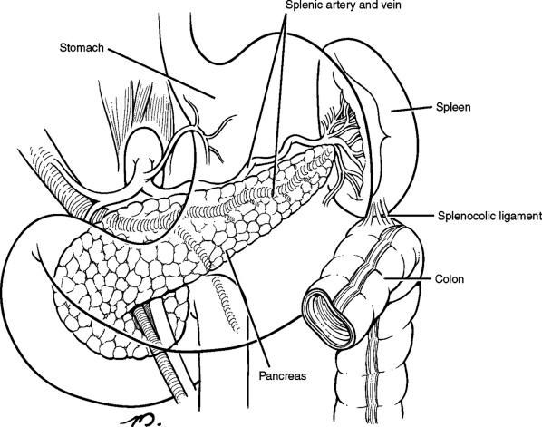 Splenectomy – Open - Clinical Tree