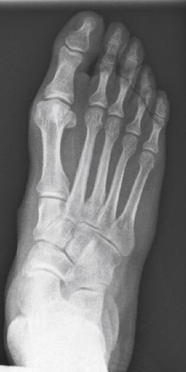 Spring Ligament Repair With Suture Tape Augmentation - Clinical Tree