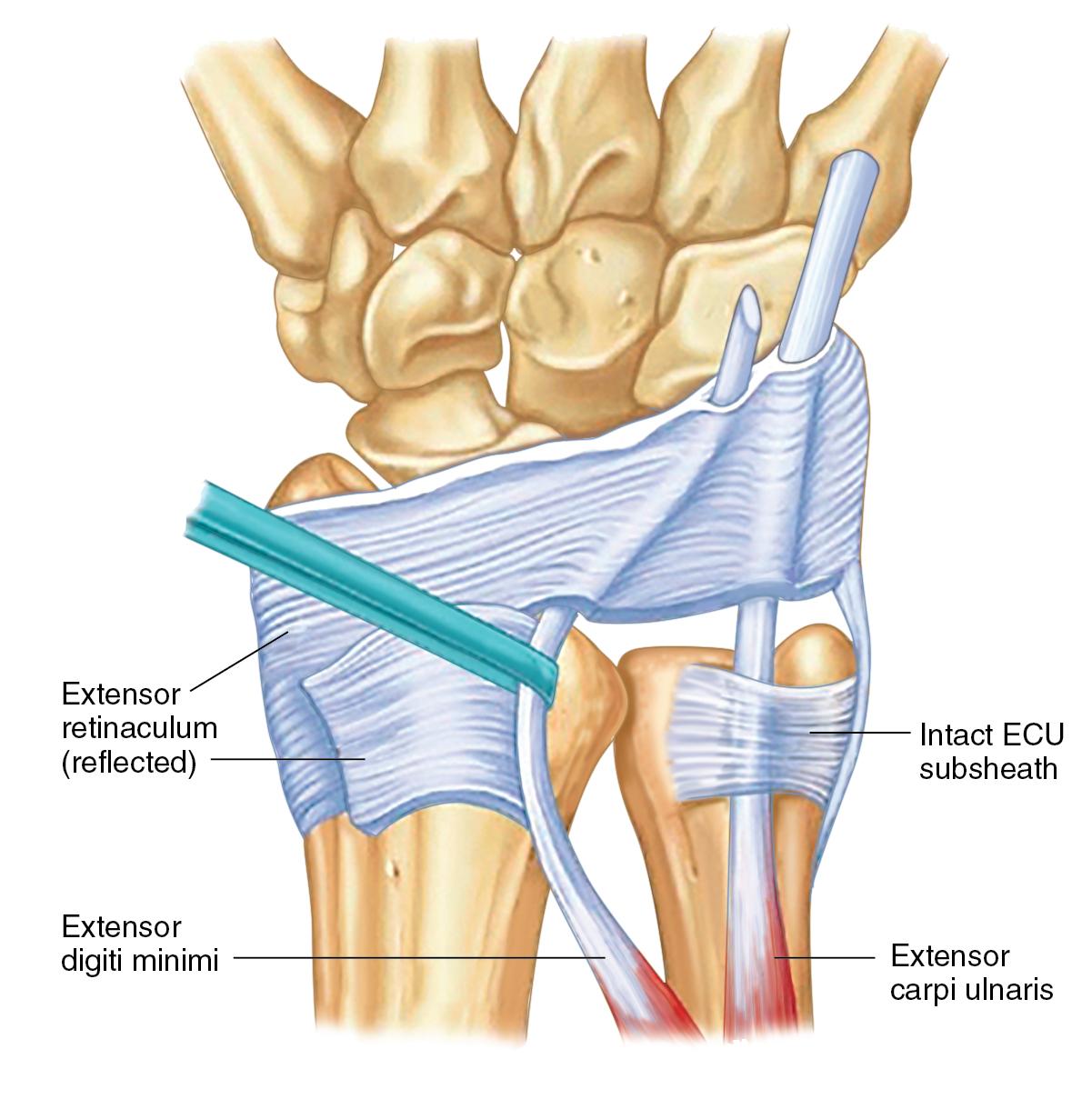 Stabilization of extensor carpi ulnaris tendon subluxation with ...