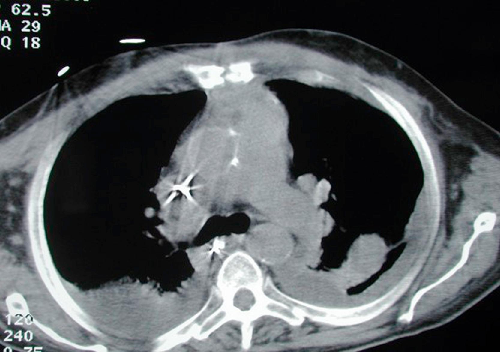Sternal Reconstruction - Clinical Tree