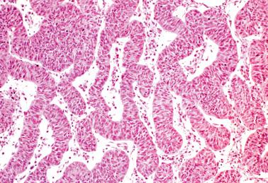 Surface Epithelial–Stromal Tumors: Endometrioid, Clear Cell ...