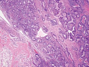 Surface Epithelial–Stromal Tumors: Endometrioid, Clear Cell ...