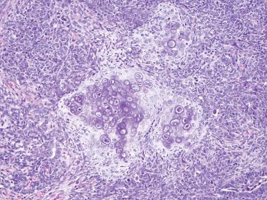 Surface Epithelial–Stromal Tumors: Endometrioid, Clear Cell ...