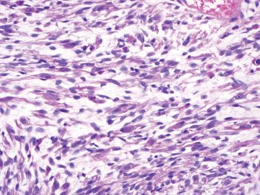 Surface Epithelial–Stromal Tumors: Endometrioid, Clear Cell ...