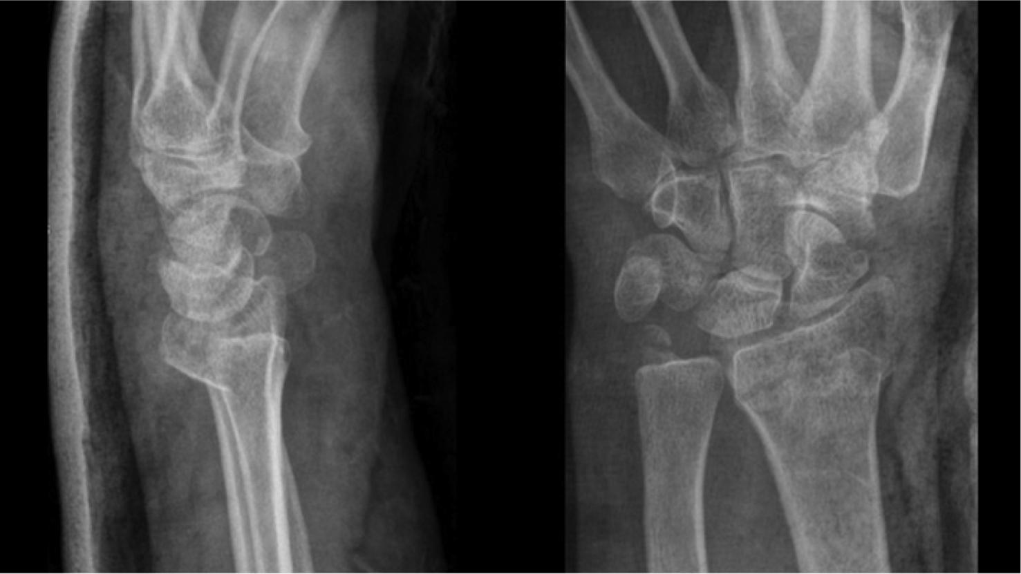 Surgical Anatomy Of The Distal Radius Clinical Tree