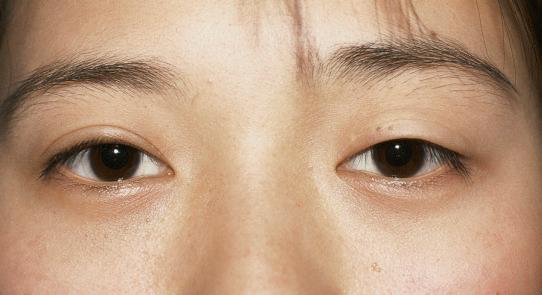 Suture Ligation Methods - Clinical Tree