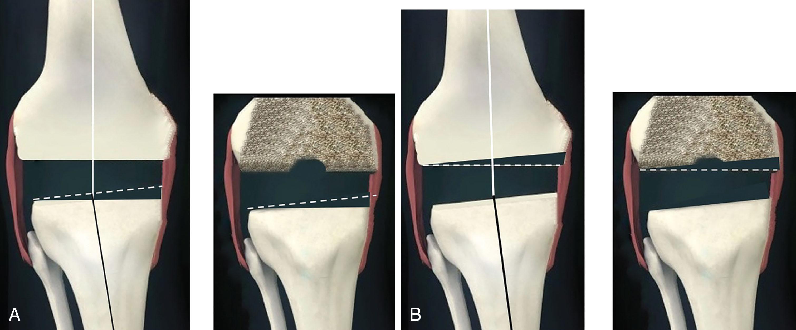 TKA Balancing - Clinical Tree