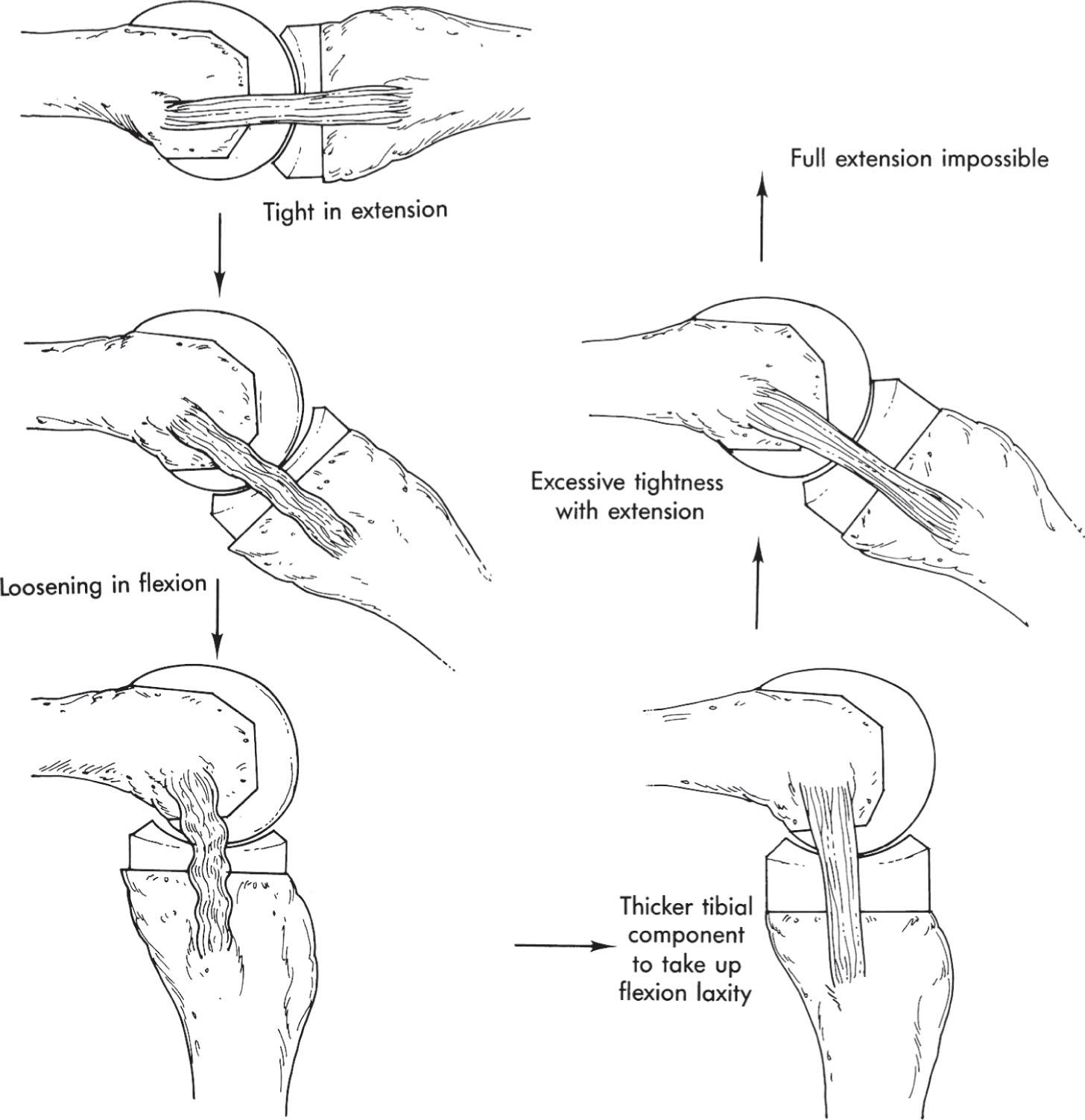TKA Balancing - Clinical Tree