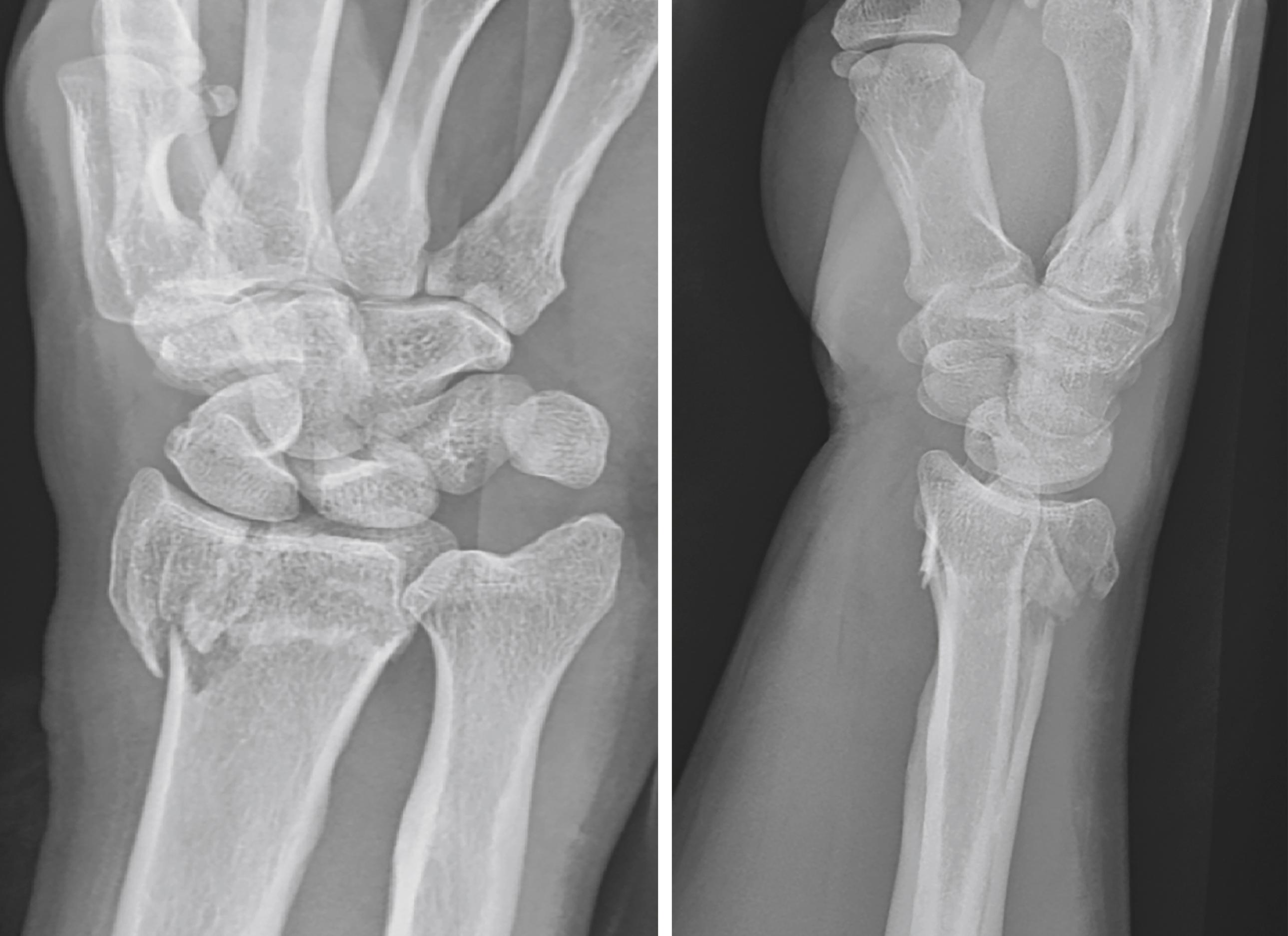 Technique Spotlight: ORIF of Intra-Articular Distal Radius Fractures ...