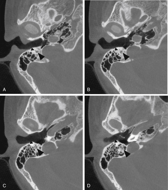 Temporal Bone Trauma - Clinical Tree