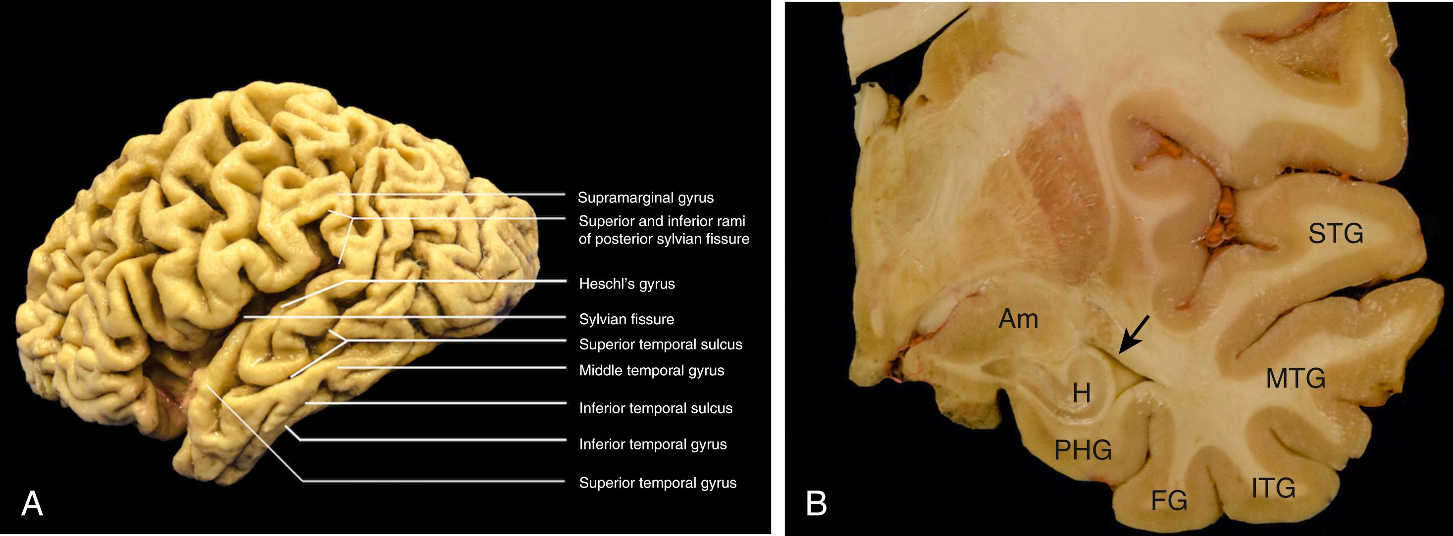 Temporal Lobe Operations in Intractable Epilepsy - Clinical Tree