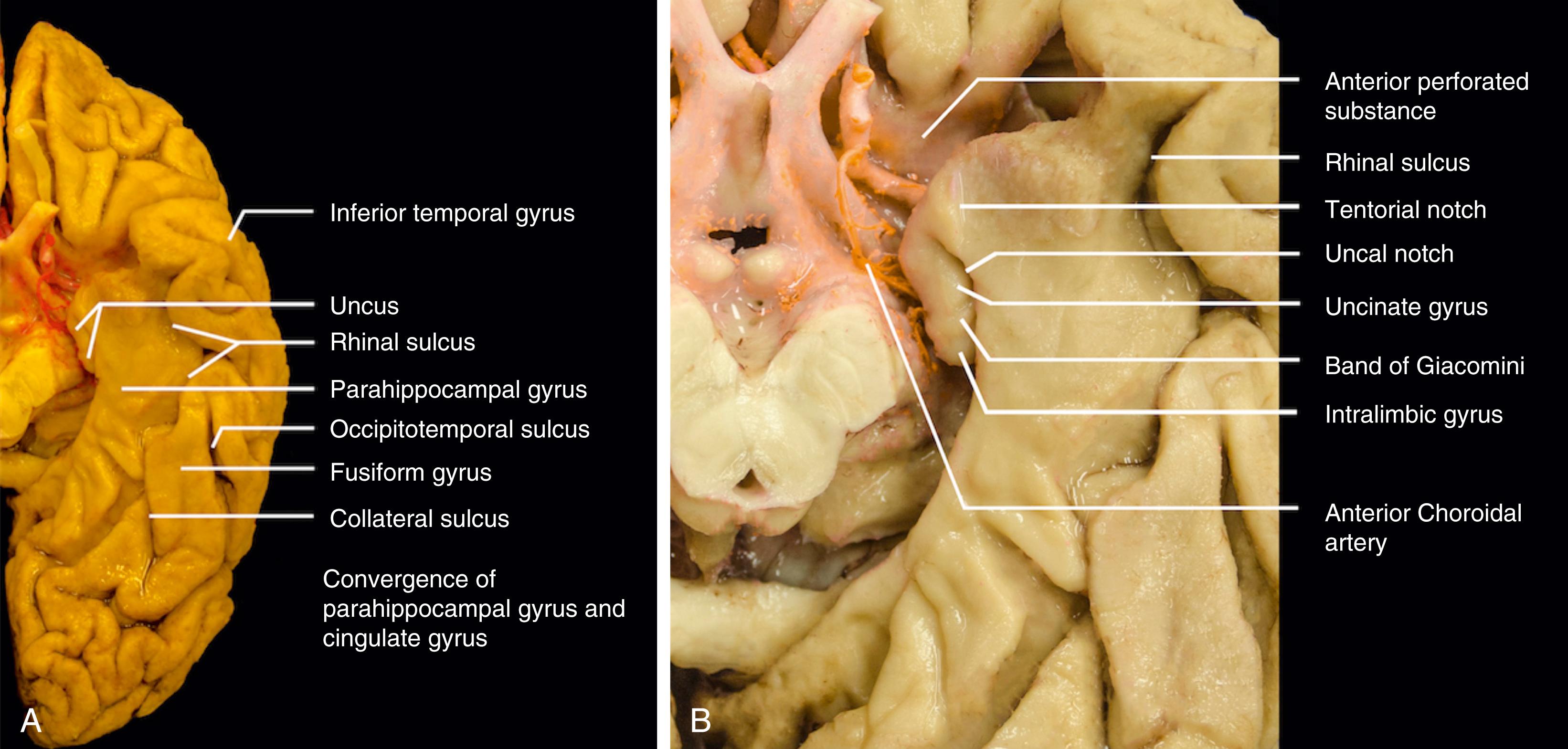 Temporal Lobe Operations in Intractable Epilepsy - Clinical Tree