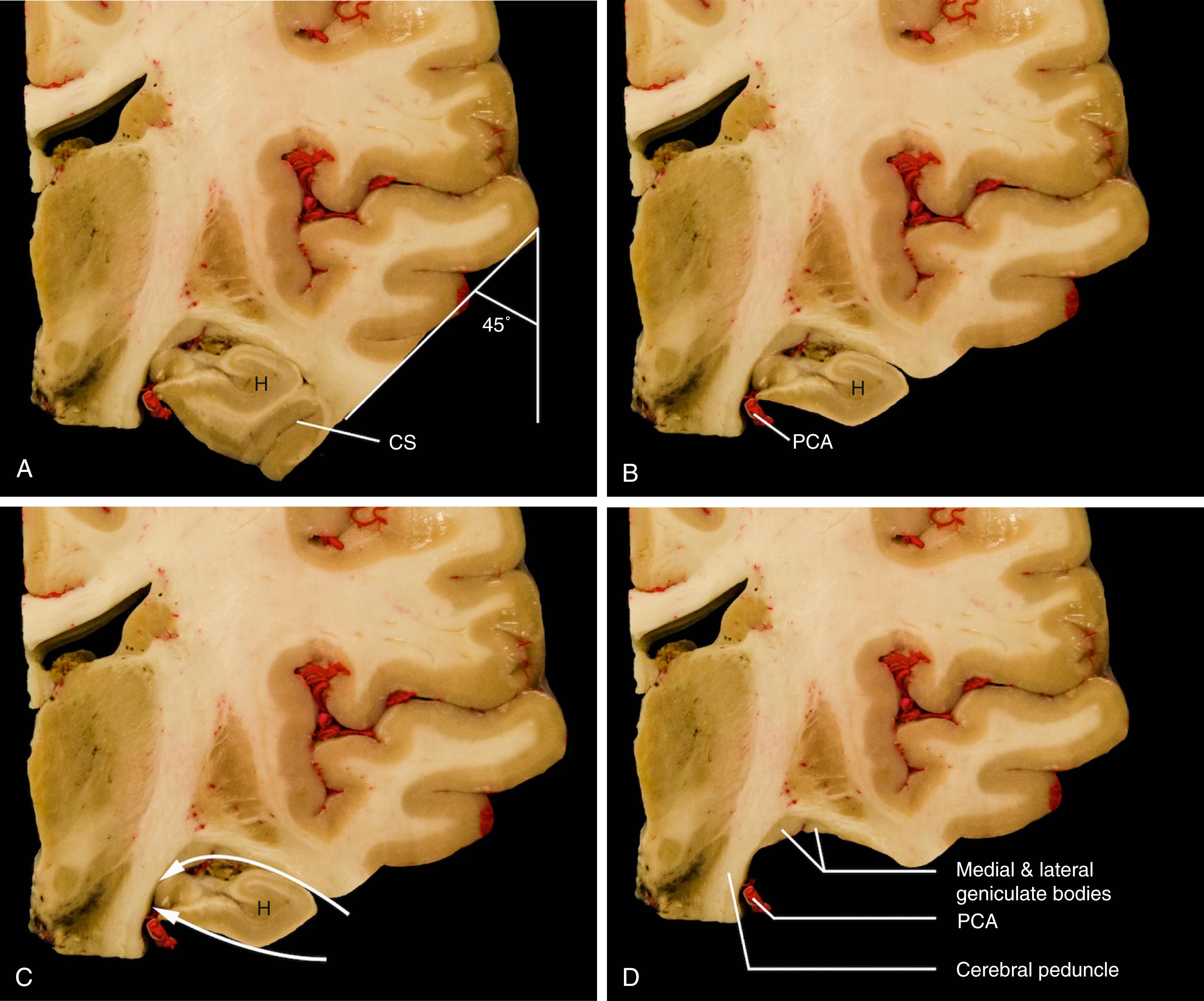 Temporal Lobe Operations in Intractable Epilepsy - Clinical Tree