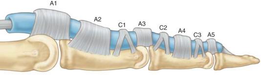 Tendon Injuries in the Hand - Clinical Tree