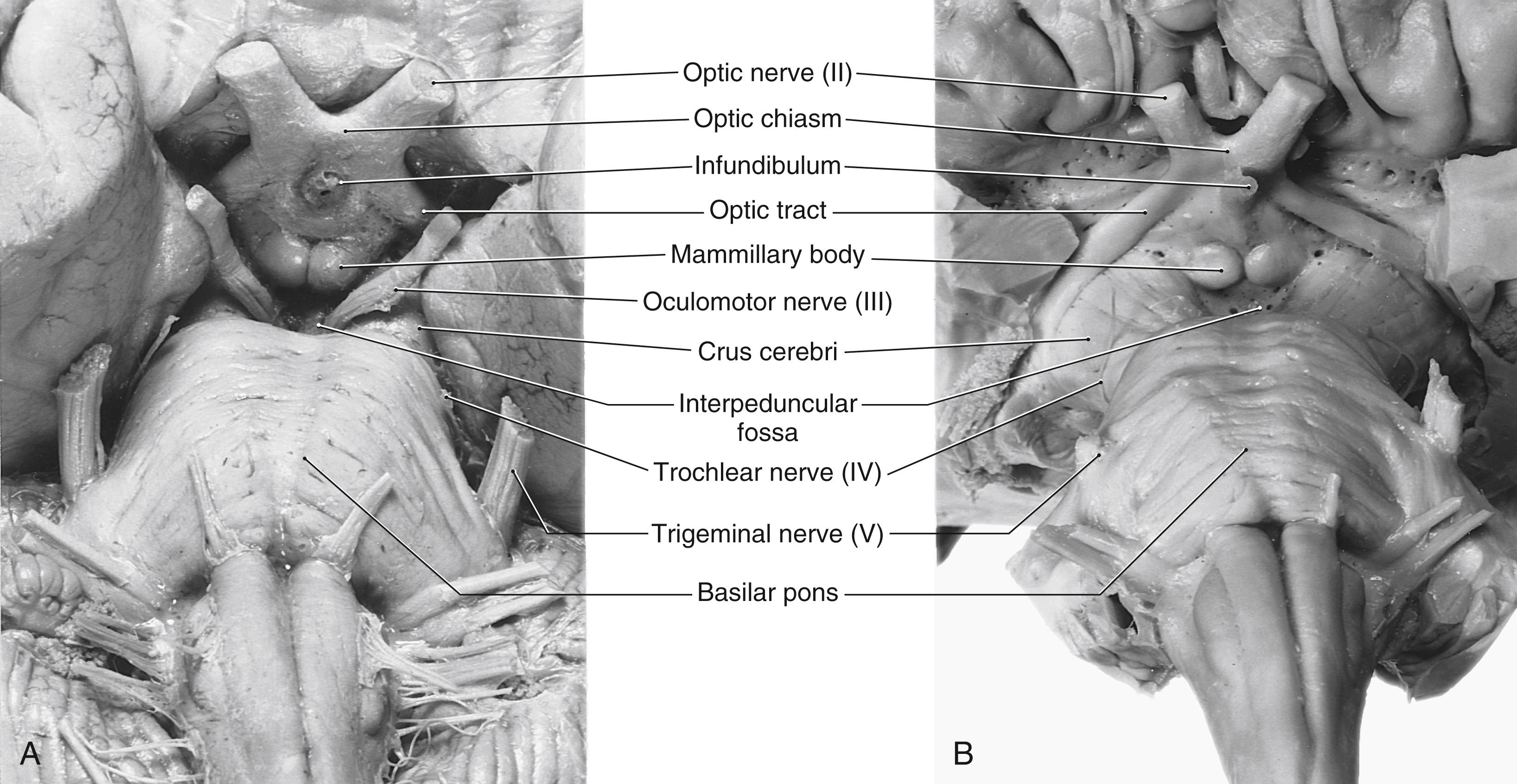 The Midbrain - Clinical Tree