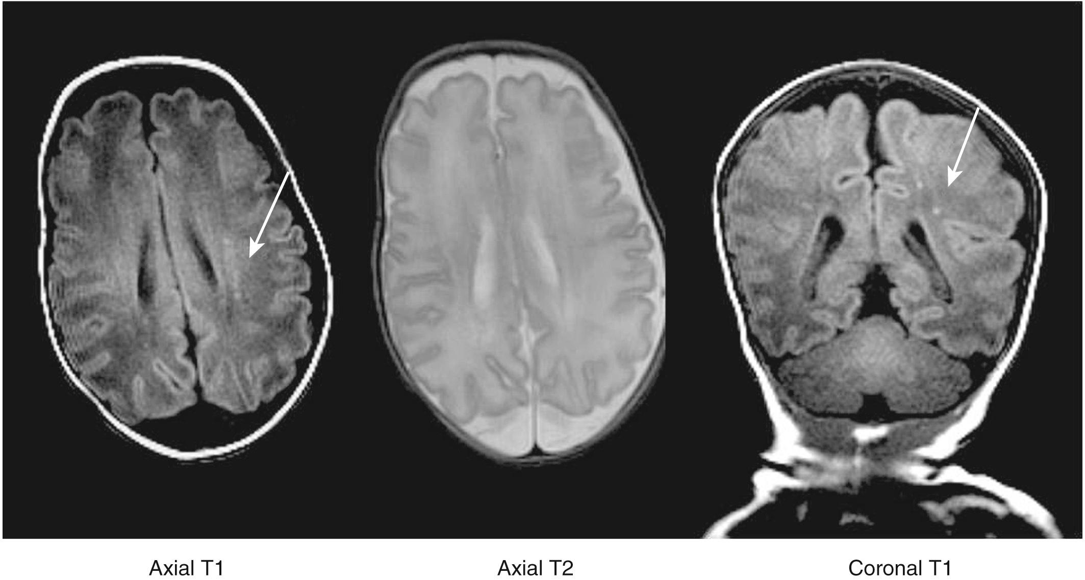 The Role of Neonatal Neuroimaging in Predicting Neurodevelopmental ...