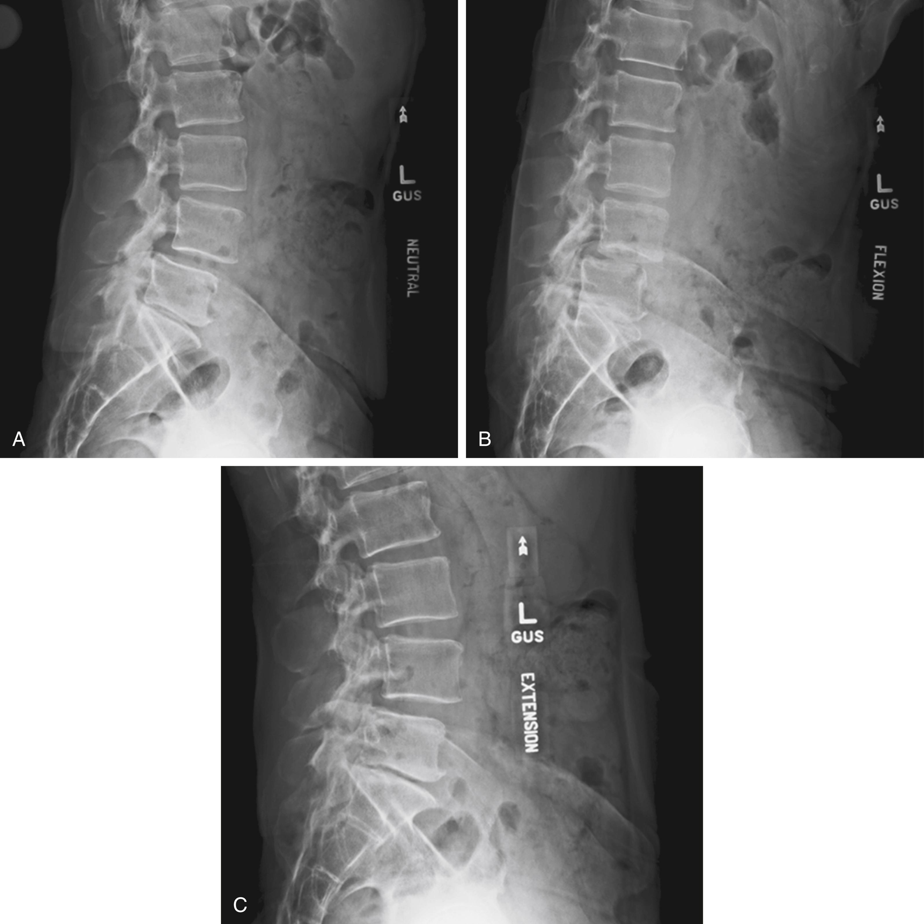 Transforaminal Lumbar Interbody Fusion - Clinical Tree